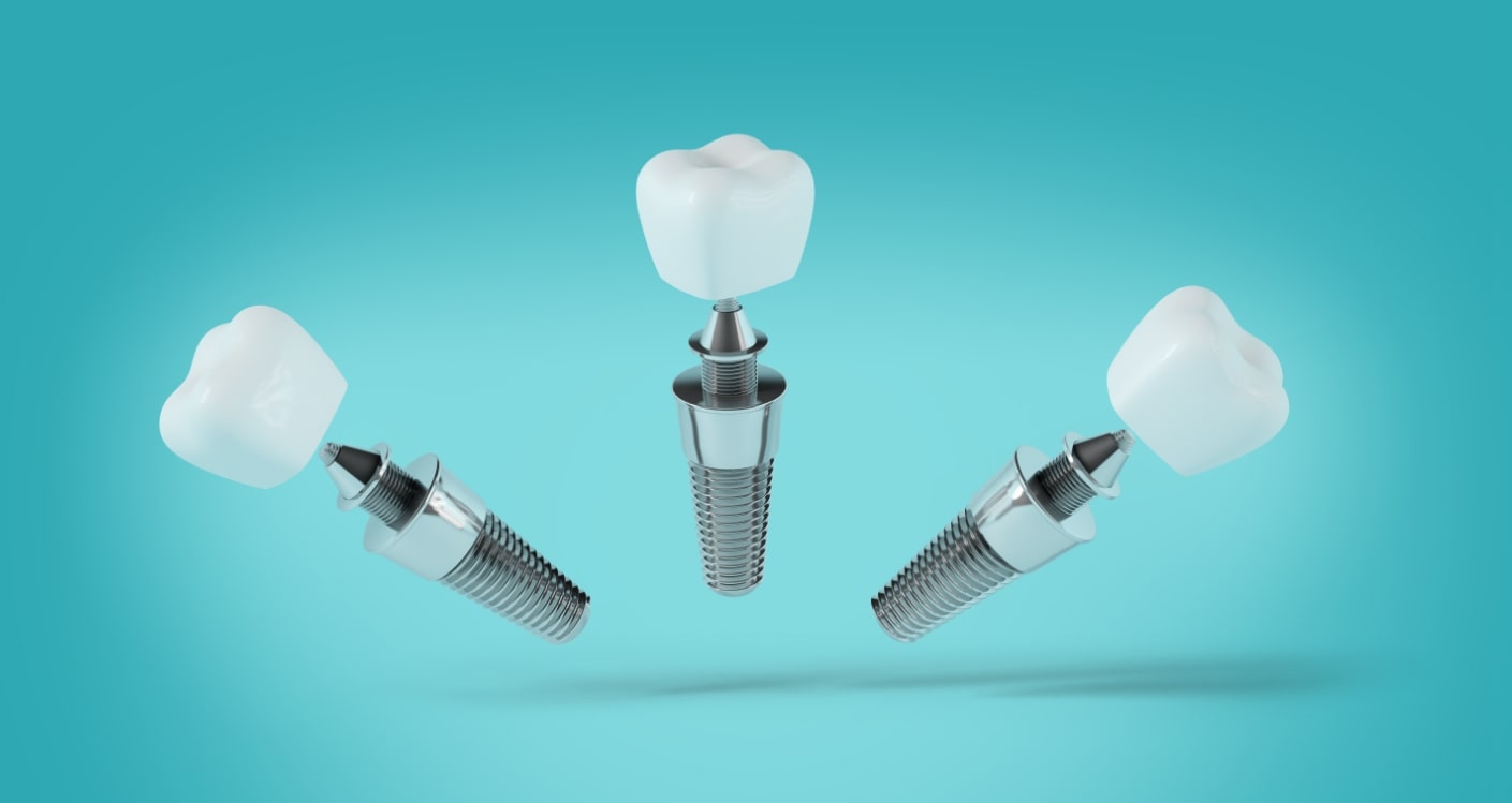 Implanturi dentare: tipuri, etape și avantaje - Alverna Dental