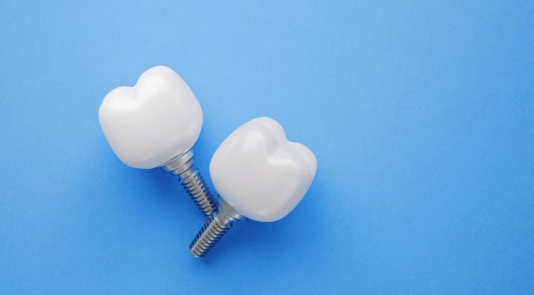 Implanturi dentare: tipuri, etape și avantaje - Alverna Dental