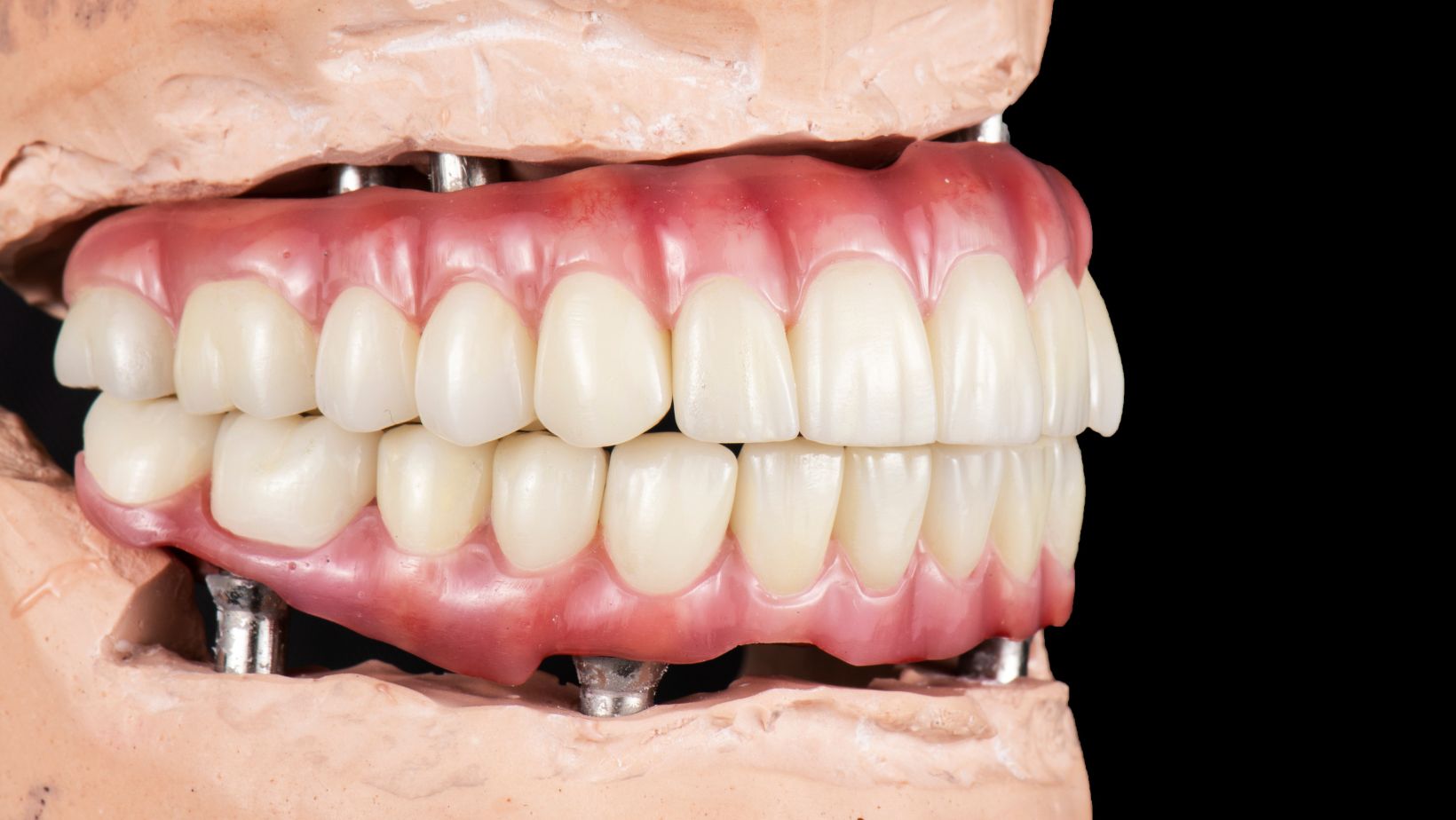 Tipuri de implanturi dentare - care este cea mai bună pentru tine?